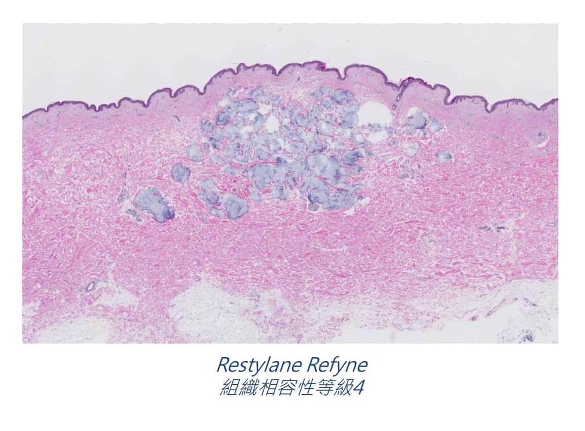 Restylane 瑞絲朗 OBT女神動態玻尿酸 - 動態表情更自然，線條更柔和 - 元晨診所